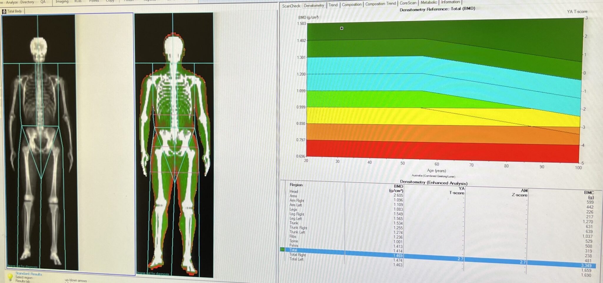 Discover The Cost Of A Dexa Scan – How Much Is A Dexa Scan – E ...